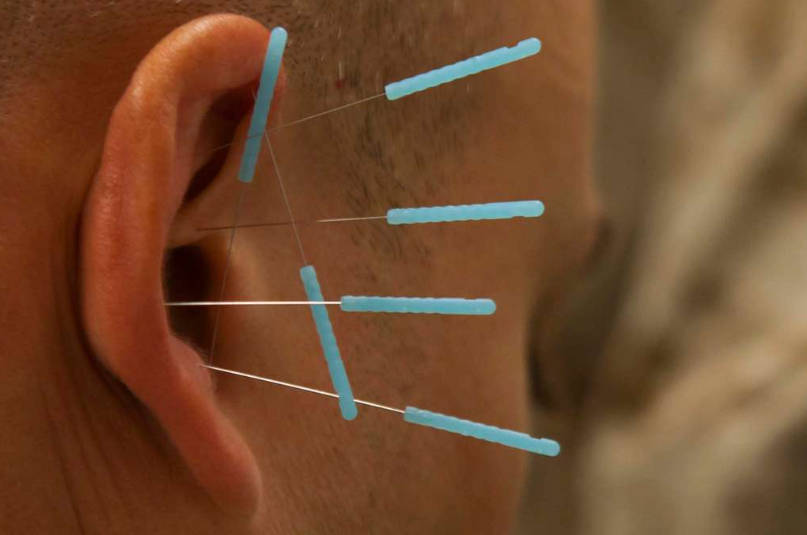 Ear Acupuncture: Benefits, Risks, and What to Expect - Health Facts Time