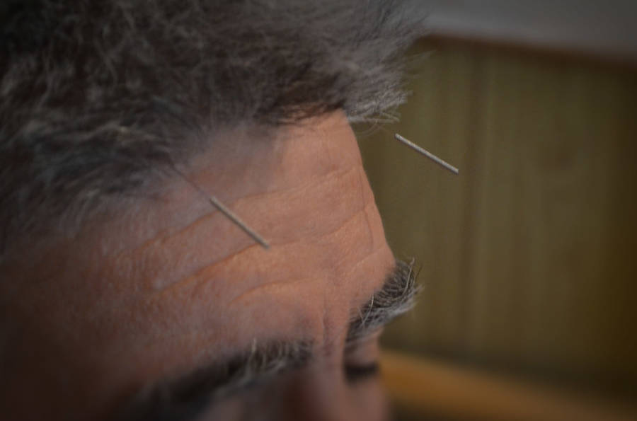 Acupuncture for Hair Loss: Benefits, Effectiveness, and More