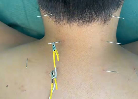 Electroacupuncture: What Is It, Benefits, Risks, and More - Health ...