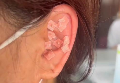 Acupressure Seeds: What They Are, Benefits, and Risks - Health Facts Time